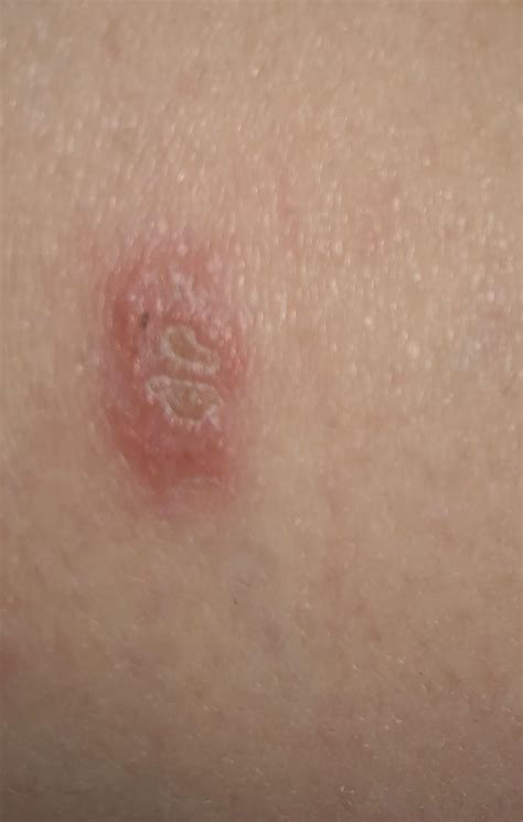 NSFW Is This A Bite R Medical