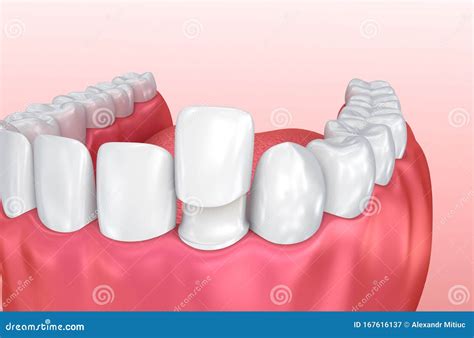 Dental Veneers Porcelain Veneer Installation Procedure Stock