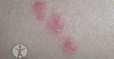 Guttate Psoriasis Image
