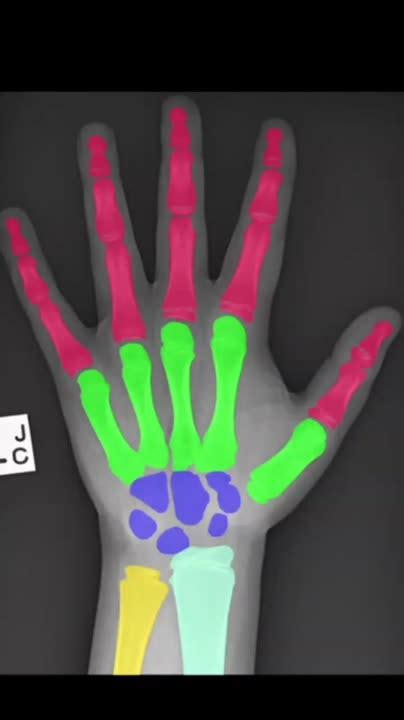 [video] Remotron On Linkedin Medicalai Dataannotation Xrayannotation Medicaldata