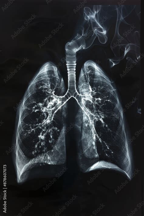 X Ray Of Smokers Lungs Showing Copd Effects For Smoking Awareness And