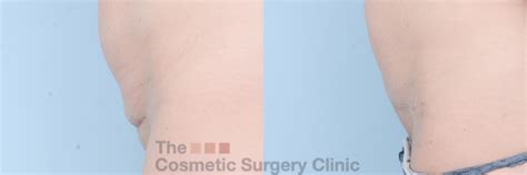C Section Scar Revision Before And After Pictures Case 600 Waterloo