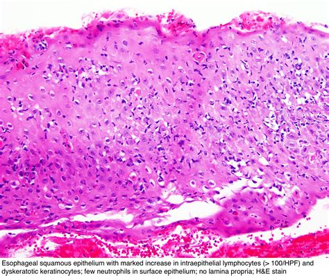 Pathology Outlines Eosinophilic Esophagitis