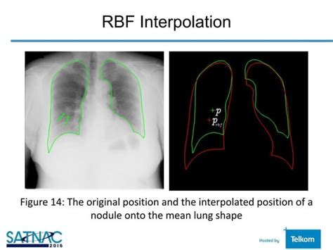 Tb Detection Using Modified Local Binary Pattern Features Ppt