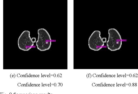 Figure 9 From An Improved Yolov3 Algorithm For Pulmonary Nodule