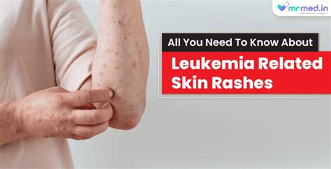 All You Need To Know About Cancer Skin Rash And Leukemia Mrmed