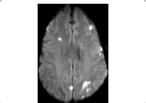 Case 3 Diffusion Weighted Brain Mri Showing Multifocal Infarctions Download Scientific Diagram