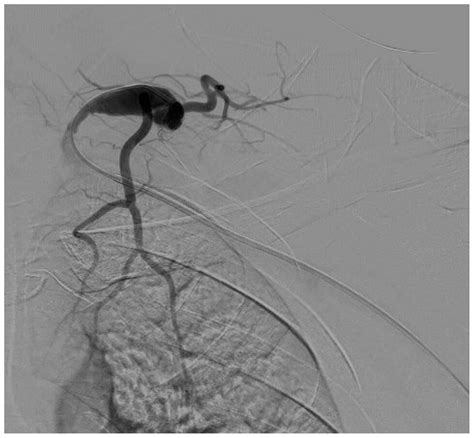 A Hybrid Endovascular And Open Approach To Rare Thyrocervical Trunk And