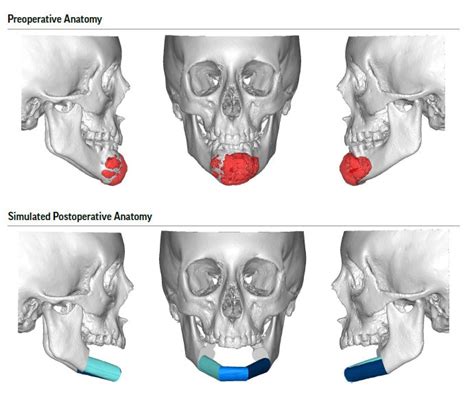 Medical Case Study Mandibulectomy With Fibula Free Flap Reconstruction