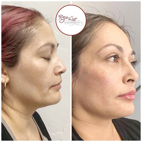 Rf Microneedling And Sofwave Rejuline Skin And Body Med Spa