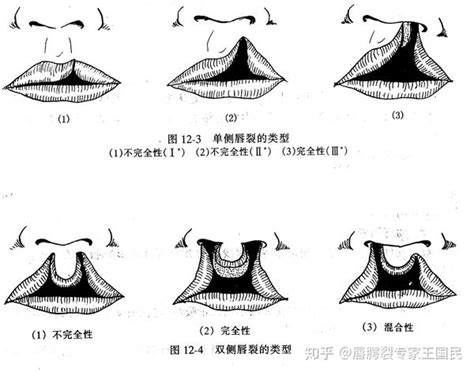 唇腭裂的分类 知乎