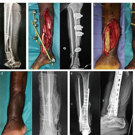 Reconstruction Of An Infected Distal Tibia Defect Sofcot Type 4 Using Download Scientific