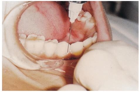 Intraligamentary Injection