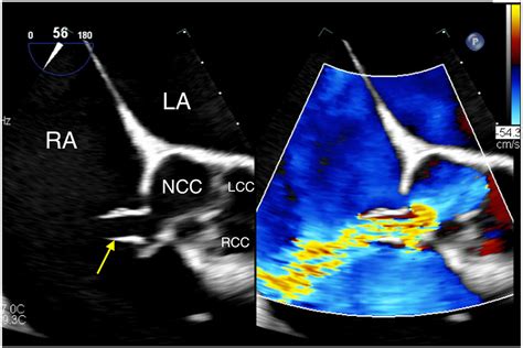 Percutaneous Closure Of A Ruptured Sinus Of Valsalva Aneurysm Under