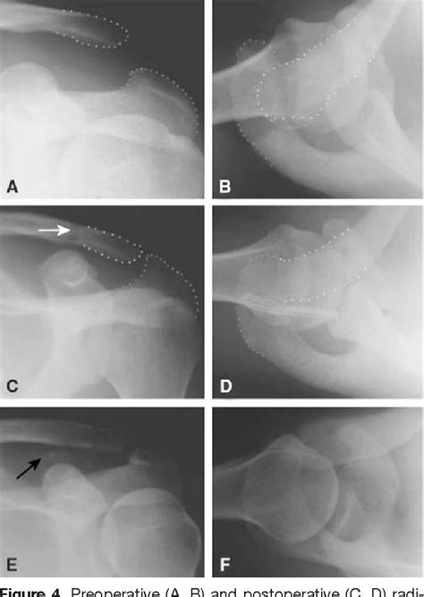 Structure Of Coracoid Process Of Scapula Semantic Scholar
