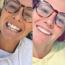 Introducing Candidpro Clear Aligners Ecologic Dentistry The Natural