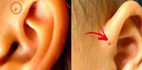 Preauricular Tag Ear