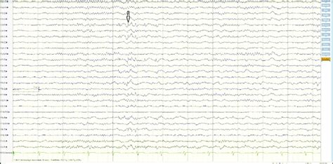 Scalp Electroencephalography EEG Sec EEG Page Longitudinal Download Scientific Diagram
