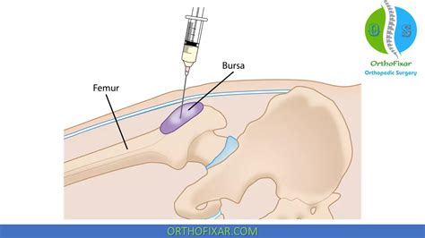 Iliopsoas Bursitis Injection