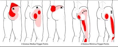 Gluteus Minimus Trigger Point
