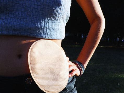 Loop Colostomy Uses And Procedure