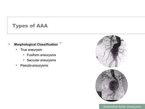 Abdominal Aortic Aneurysm Ppt