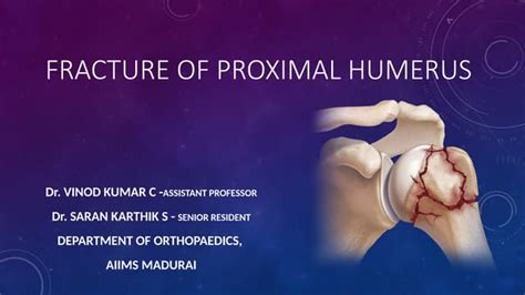 Fracture Of Proximal Humerus Etiopathogenesis Clinical Features And Management Pptx