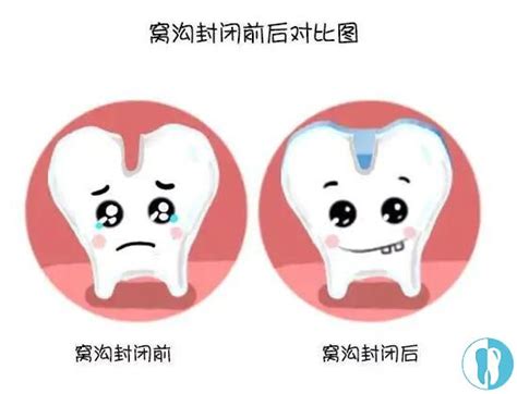 预防蛀牙 千万不要错过儿童窝沟封闭和涂氟的黄金年龄 口腔资讯 牙齿矫正网