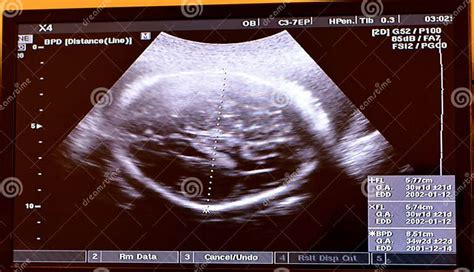 Ultrasonography On The Uterus Of A Pregnant Woman Showing A Healthy