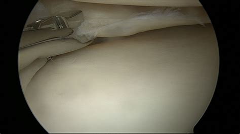 Partial Meniscectomy Frequently Asked Questions Dr Geier