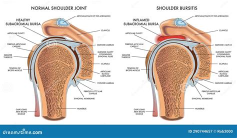 Medical Illustration Of Shoulder Bursitis Stock Vector Illustration