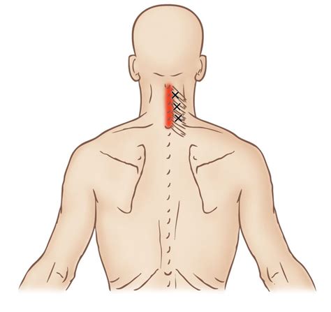 Rotatores Cervical Trigger Point Learn Muscles