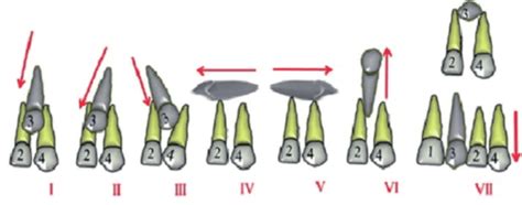 Classification Of Canine Impaction According To Yamamoto Et Al 2003