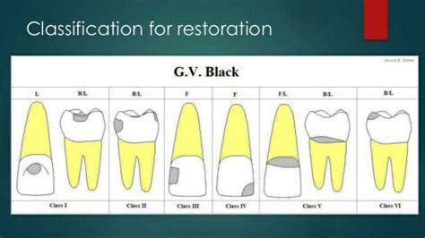 Classification For Restoration By Black Dental Caries Dental Dental Hygiene School