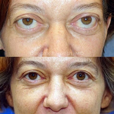 Orbital Decompression Center For Eye And Facial Plastic Surgery