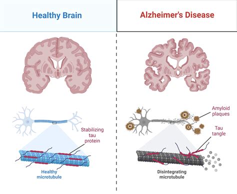 Alzheimers Disease Affects Alzheimers Disease Understanding Motor