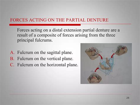 Designing For Kennedy Class I And Class Ii Ppt Oral Care Personal Care