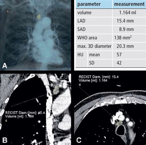 Semi Automated Lymph Node Segmentation Of A Node Of The Upper Download Scientific Diagram