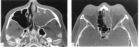 A Typical Case Of Type 3 Sinusitis A Panoramic Radiograph There Are Download Scientific