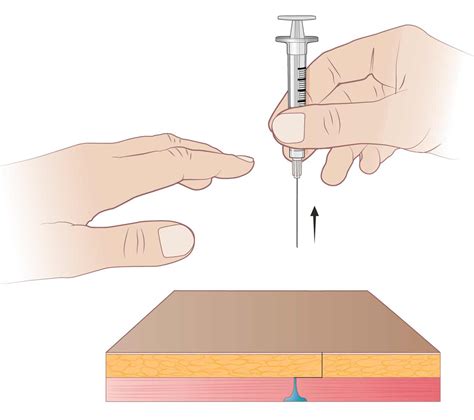 Z Track Injection Definition And Patient Education