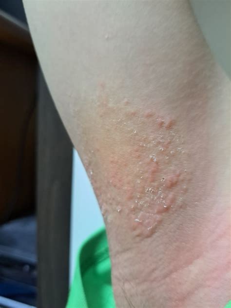 팔뚝 안쪽에 두드러기 지식in