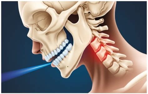 Is A Tmj Dental Splint Really The Answer Understanding Effectiveness
