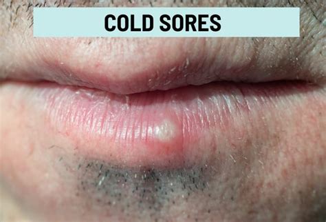 Cold Sores Pictures Of What They Look Like And Symptoms