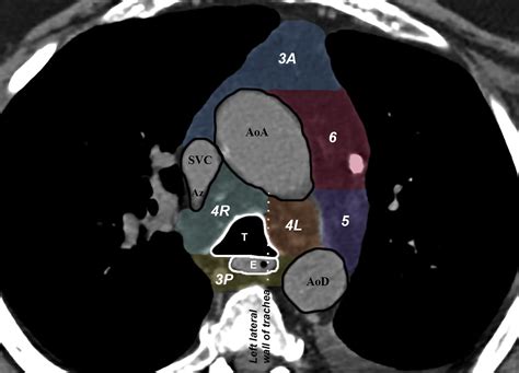 Pulmonologists Road Map To Mediastinal Lymph Node Imaging Clinics In