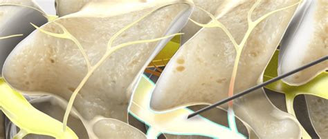 Selective Nerve Root Block Procedures You Can Trust