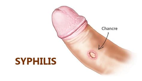 يعتقد الطبيب أنك مصاب بحالة مرضية تدعى