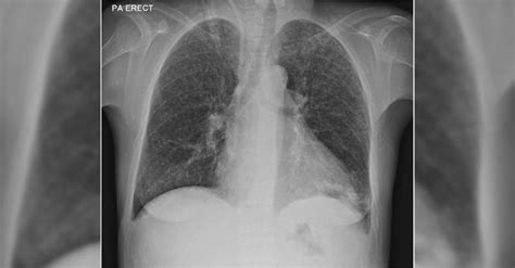 A Case Of Metastatic Pulmonary Calcification In A Woman With An Atypical Ct Thorax Feature