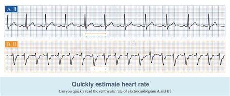 Quickly Estimate Heart Rate Stock Image Image Of Cardiology Education 379742949