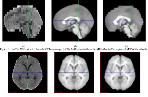 figure 1 from non rigid registration between brain ct images and mri brain atlas by combining
