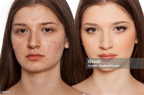 하얀 배경에 피부 반질 전후의 문제가있는 피부를 가진 십대 소녀의 만화 포틀릿 16 17 살에 대한 스톡 사진 및 기타 이미지 16 17 살 개념 개선 Istock